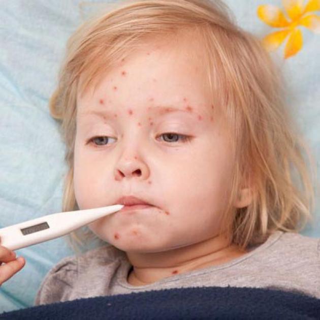 Varicela la copii, varsat de vant | SfatulMamicilor.ro
